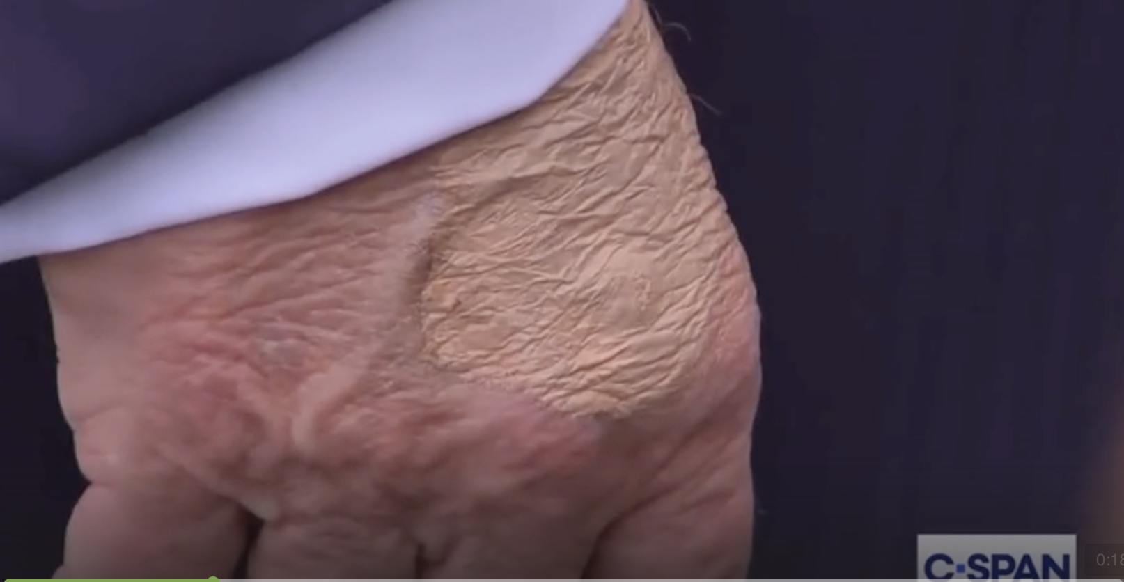 WATCH: C-SPAN Captured Bruising On President Trump's Hand Ahead Of ...